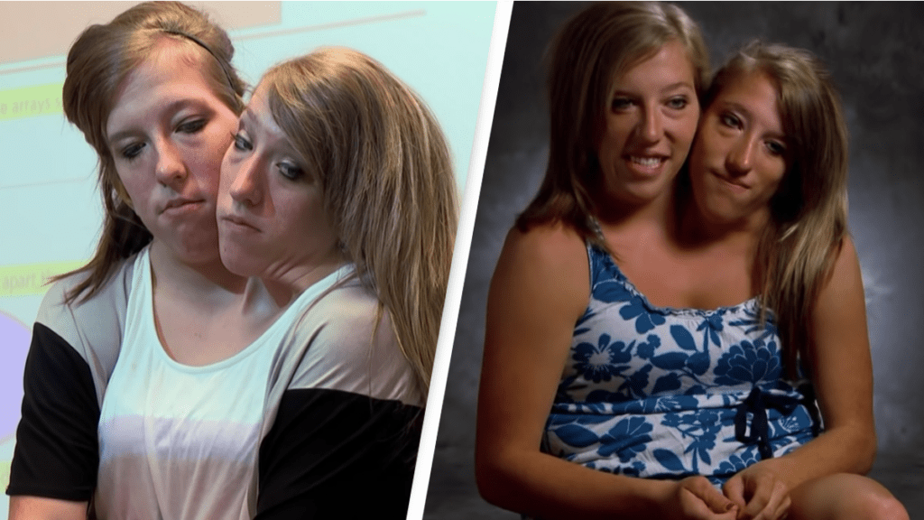 Where are Conjoined Twins Abby and Brittany Now?